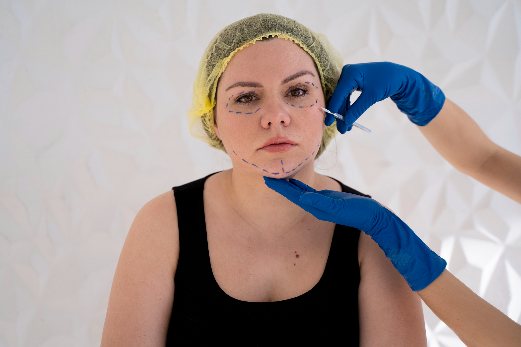 The Science behind HIFU: Non-Surgical Face Lifting Explained - Exella ...